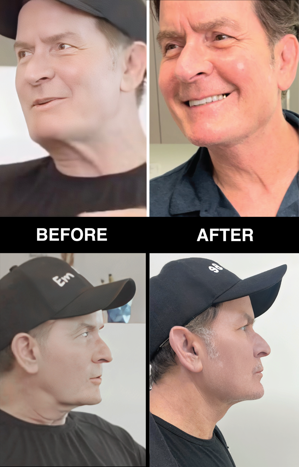 SURGYLIFT™ - Y LIFT