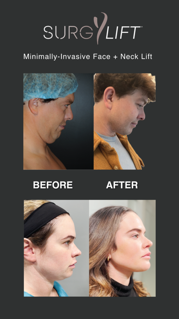 SURGYLIFT B&A - Y LIFT