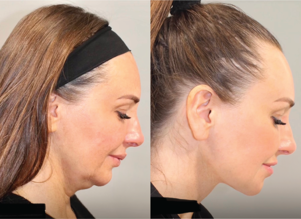 SURGYLIFT B&A - Y LIFT