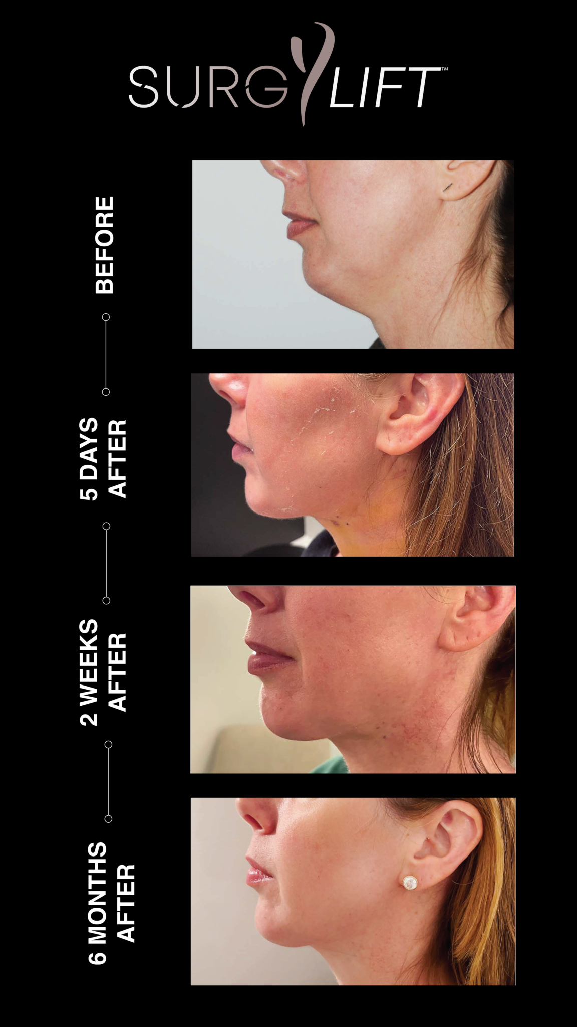 SURGYLIFT B&A - Y LIFT